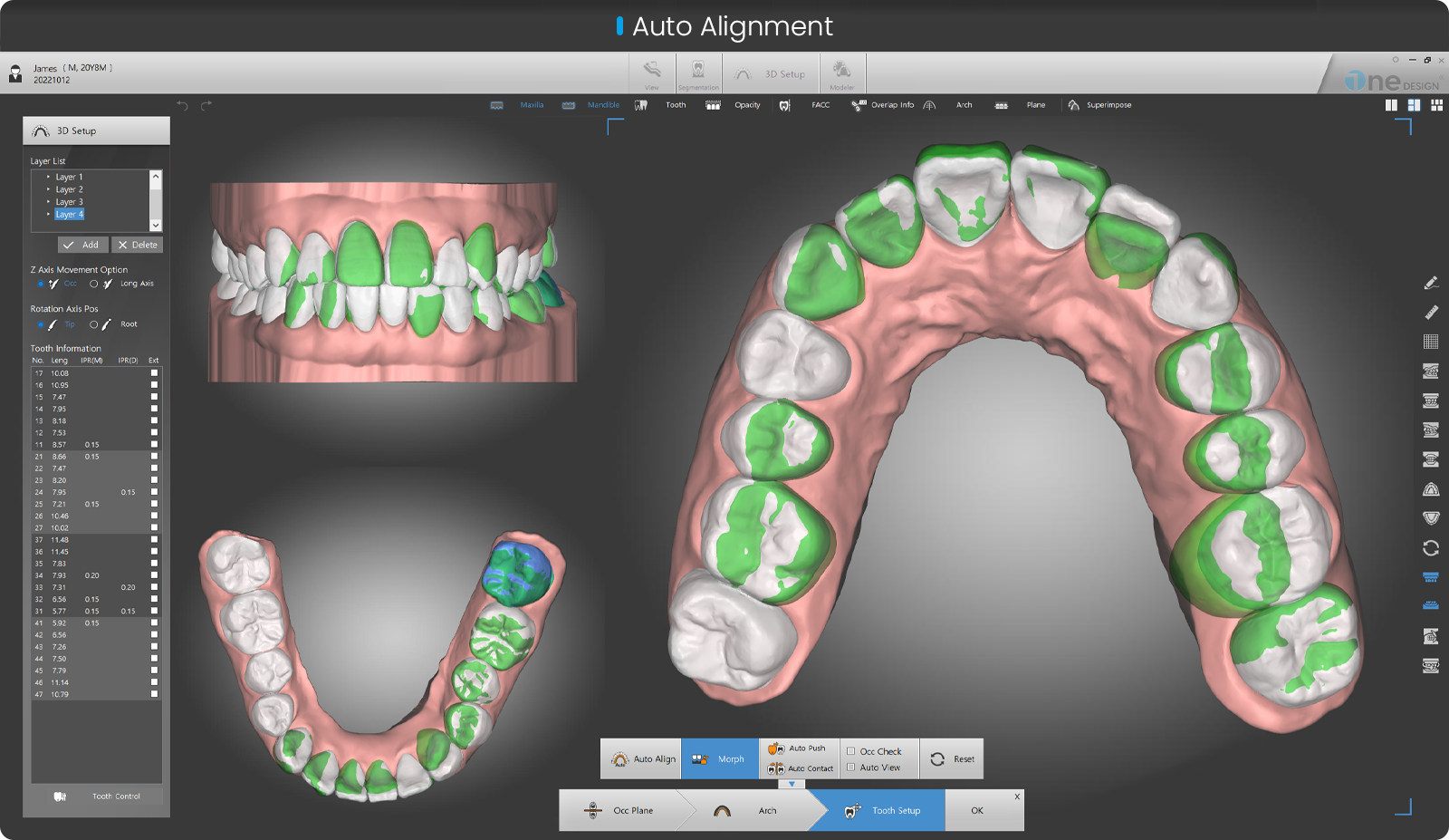 dentOne - clearaligner / 3D Orthodontic Software