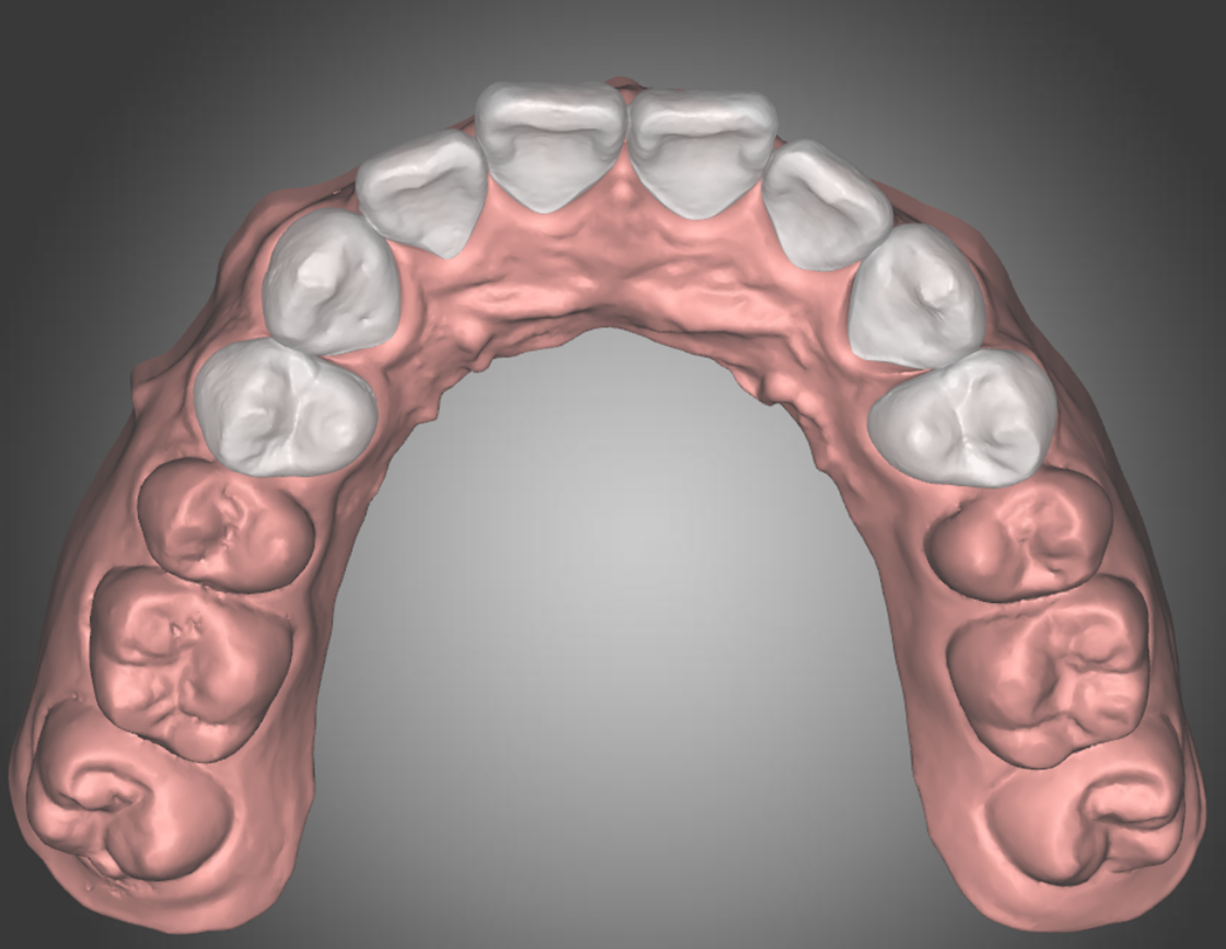 knowhow-design - dentOne / clearaligner / 3D Orthodontic Software