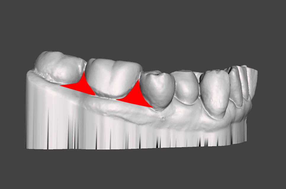 knowhow-thermoform - dentOne / clearaligner / 3D Orthodontic Software