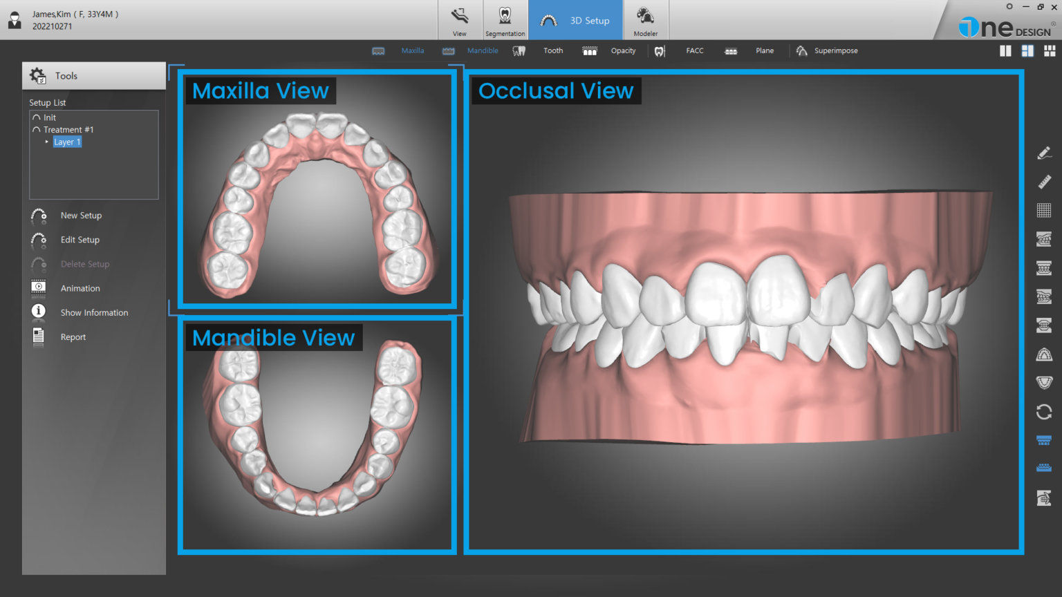 designsoftware-common - dentOne / clear aligner / 3D Orthodontic Software