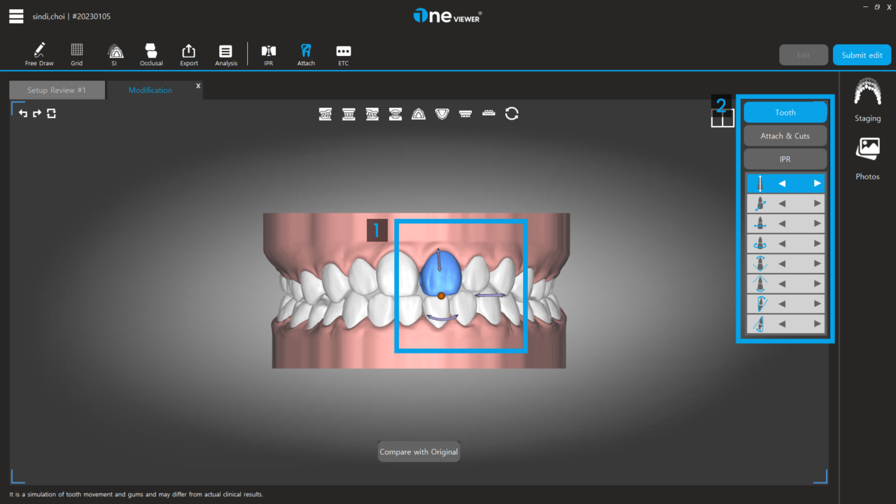 viewer-review - dentOne / clear aligner / 3D Orthodontic Software