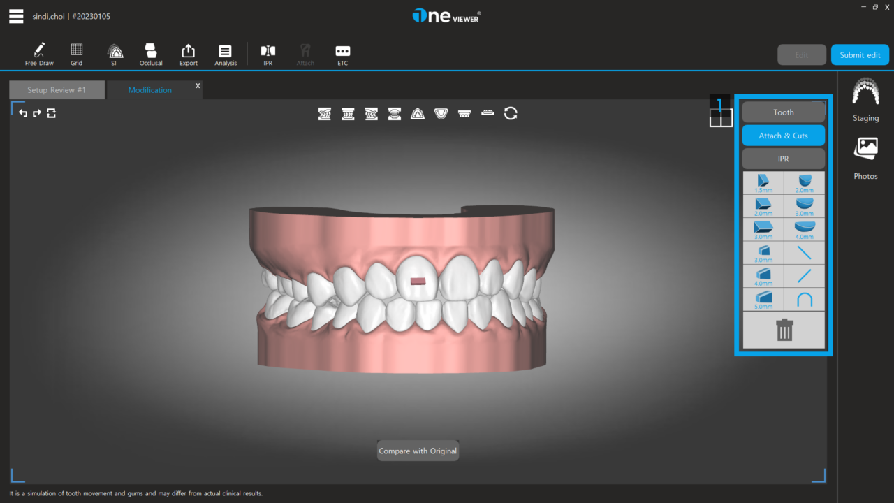 viewer-review - dentOne / clear aligner / 3D Orthodontic Software